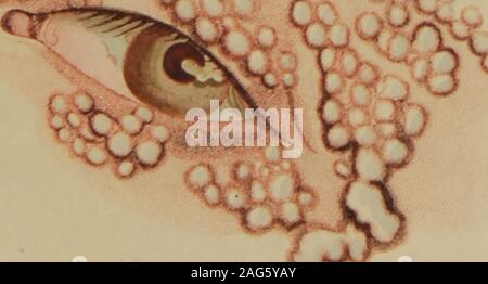 . Description de l'insigne, anastomosé, inoculé et la variole, maladie ...