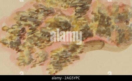 . Description de l'insigne, anastomosé, inoculé et la variole, maladie ...