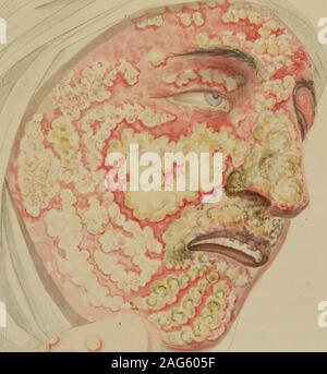 . Description de l'insigne, anastomosé, inoculé et la variole, maladie ...