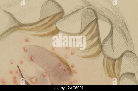 . Description de l'insigne, anastomosé, inoculé et la variole, maladie ...