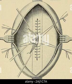 Chirurgie du dispositif . Fig. ^ sacciform 244.-withcatheter anévrisme ...