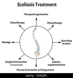 Symptômes de lordose. La courbure de la colonne vertébrale, la scoliose ...