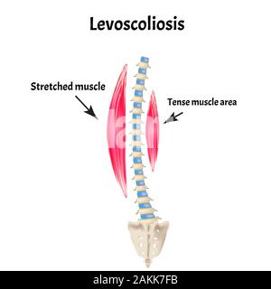La scoliose de latéralité gauche. Levoscoliosis. Les muscles et la ...