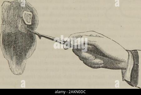 Amputation au-dessous du genou gauche, moignon de patient avec diabète ...