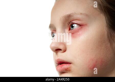 Dermatite et allergie dans les yeux, maladie dermatologique et ...