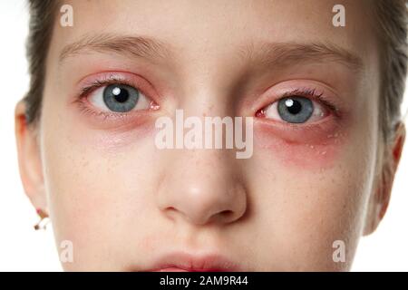 Dermatite et allergie dans les yeux, maladie dermatologique et ...