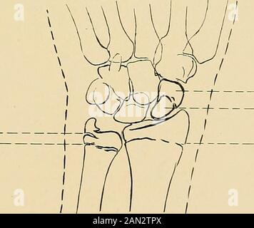 Le traitement des fractures . Ulna. Ligne de fracture. Fig. 298 ...