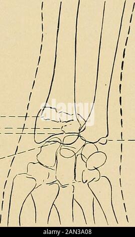 Le traitement des fractures . Ulna. Ligne de fracture. Fig. 298 ...