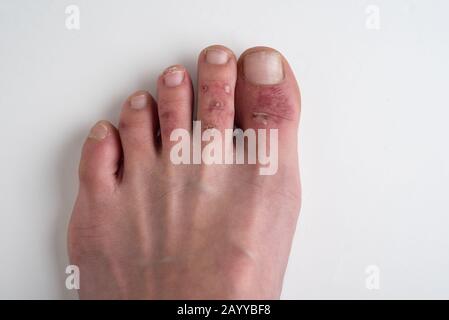 Psoriasis sur le pied isolé sur fond blanc Photo Stock - Alamy