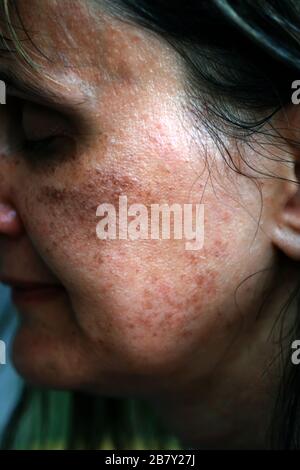 Tache brune sur la peau. Taches pigmentées et moles. Mole et poils de ...