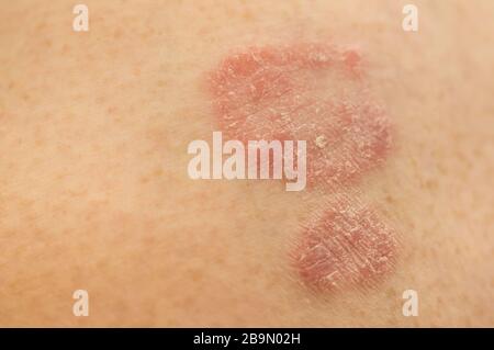 Santé de la peau le psoriasis maladie maladie maladie santé main macro ...