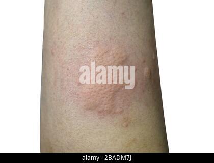 Urticaire (urticaire), un état de la peau. Éruption cutanée rouge sur ...