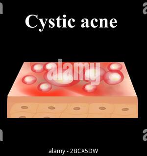 Acné de kyste. Acné sur la peau d'un kyste. Maladies dermatologiques et ...