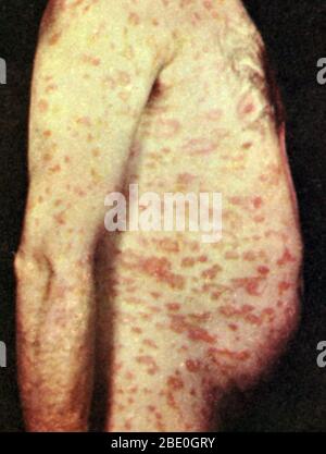éruption cutanée prurigineuse Photo Stock - Alamy