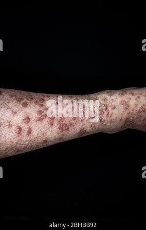 PSORIASIS SUR PIED Photo Stock - Alamy