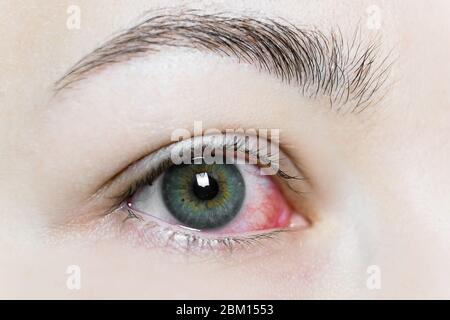 Gros plan sur un œil rouge effusion de sang. Blepharitis viral ...