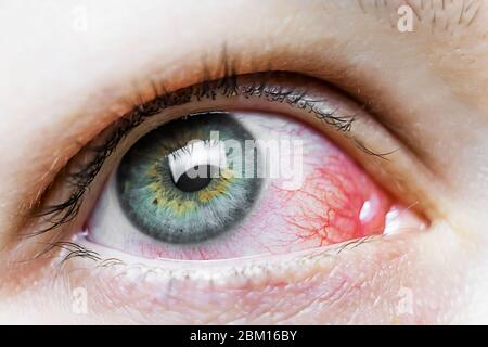 Gros plan sur un œil rouge effusion de sang. Blepharitis viral ...