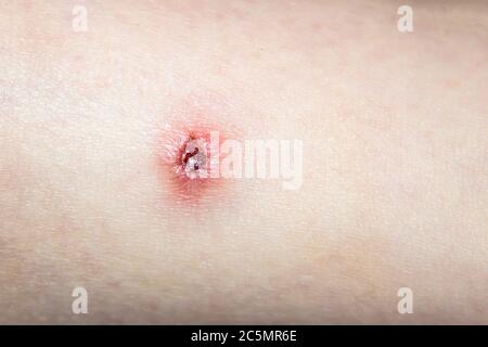 Blessure déchirée de l'inflammation, acné sur la peau humaine. Plaie ...