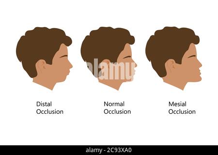 Profil de morsure distal, normal et mésial, illustration vectorielle ...