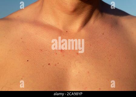 Gros plan de furoncle, acné, bouton avec pus sous la peau Photo Stock ...