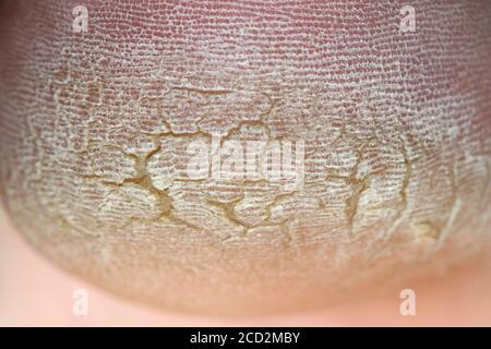 Femme avec pied talon fissuré ou que la dermatite dermatologie concept ...