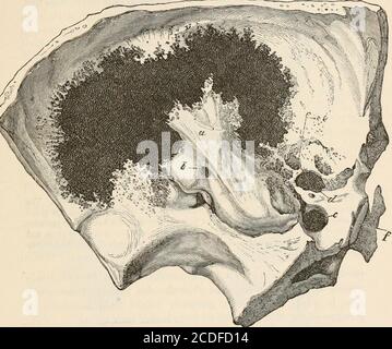 L'OREILLE DE CARCINOME Photo Stock - Alamy