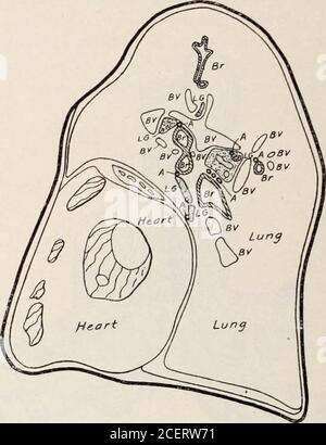Pneumonie du poumon droit (infection respiratoire aiguë) révélée par ...