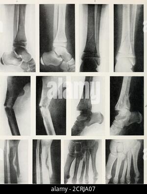 Une radiographie montre une fracture de l'articulation de la cheville ...