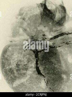 Kyste rénal, X-RAY Photo Stock - Alamy