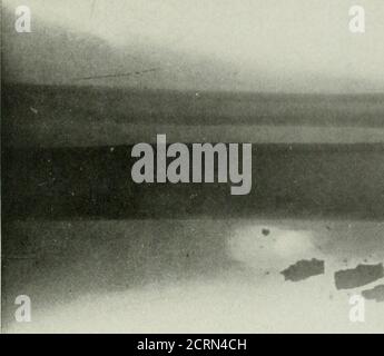 Pleurésie et pneumothorax Photo Stock - Alamy