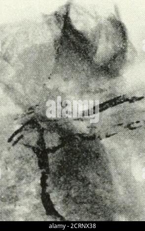 Kyste rénal, X-RAY Photo Stock - Alamy