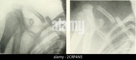 X-ray de l'épaule avec fracture de l'omoplate Photo Stock - Alamy