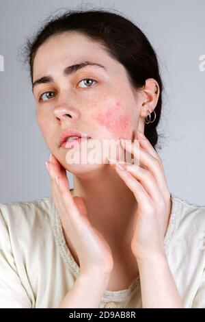 Concept de traitement de couperose. Portrait d'une jeune femme effrayée ...