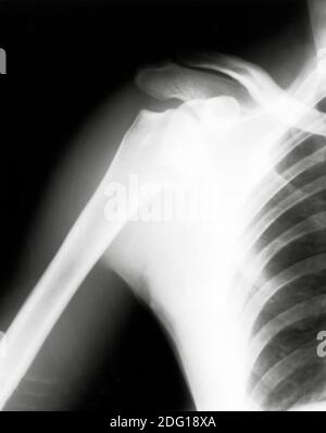 X-ray la radiographie de l'épaule Photo Stock - Alamy