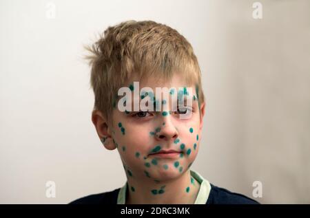 Enfant avec éruption virale sur le visage Photo Stock - Alamy