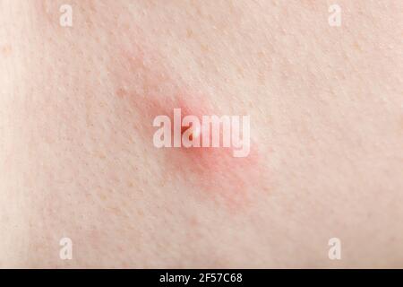 bouton purulent sur la peau humaine enflammée gros plan, la santé du ...