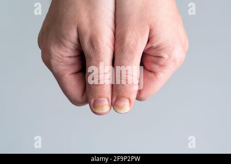 Mycose de l'ongle, symptômes de champignon sur un doigt de main.Exemple ...