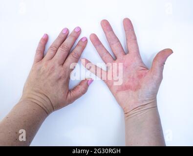 Dermatite atopique, mains rouges, problème dermatologique, mains ...
