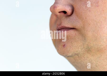 Bouton sur le nez rouge Photo Stock - Alamy