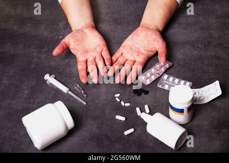 Éruptions cutanées sur les mains. La dermatite allergique, problèmes ...