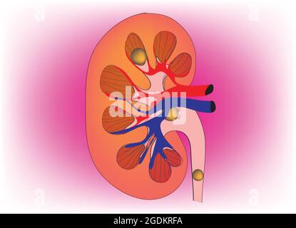 Illustration médicale de calculs urinaires, calculs rénaux, calculs ...