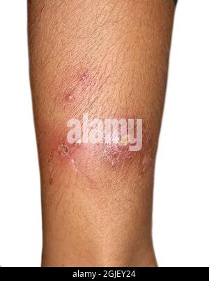 Pustules ou infection staphylococcique dans la jambe de l'enfant ...