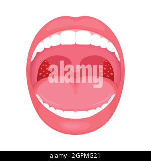 L'infection streptococcique de la gorge Photo Stock - Alamy