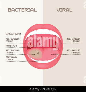 L'infection streptococcique de la gorge Photo Stock - Alamy