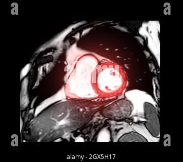 IRM cardiaque ou cardiaque IRM ( imagerie par résonance magnétique ) du ...