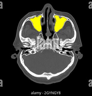 Anatomie des sinus paranasaux, acquisition CT Photo Stock - Alamy