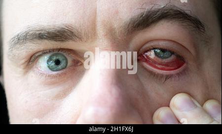 Gros plan sur un œil rouge effusion de sang. Blepharitis viral ...