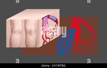 Varice sur une femme hauts les jambes. La structure de la normale et ...