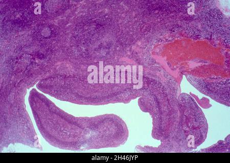 Glande parotide : kyste lymphoépithélial avec VIH Photo Stock - Alamy