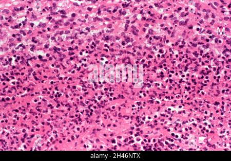 La leishmaniose cutanée Photo Stock - Alamy